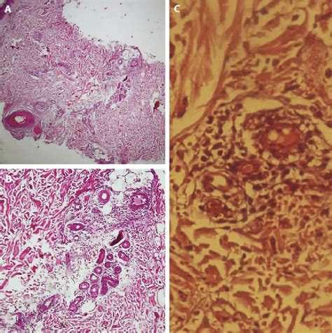 A Soft Tissue Edema Within The Deep Dermis And Around Eccrine Coil Download Scientific