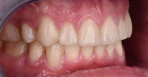 Worn Dentition Rehabilitation With Direct Composite Restorations