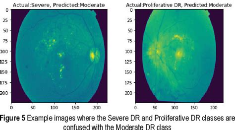 Figure 1 From Deep Learning Based Models For Detection Of Diabetic Retinopathy Semantic Scholar