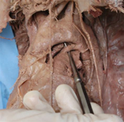 Ligamentum Arteriosum Diagram Quizlet