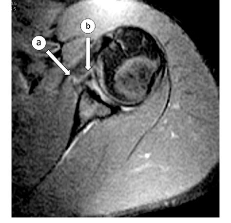 Bankart Lesion Mri Remplissage Austin Tx Shoulder Arthroscopic