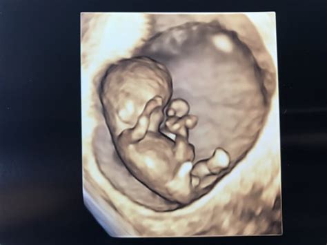 12 Week 3d Ultrasound Gender