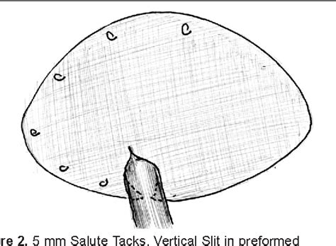 Consent Type Herniogram Semantic Scholar