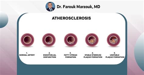 Atherosclerosis Symptoms Causes And Treatment