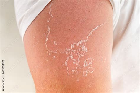Sunburn Peeling Face