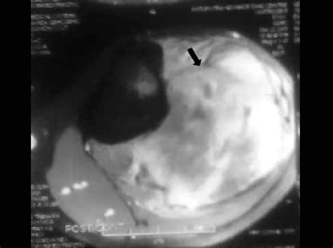 C Stir Post Contrast Axial Showing Heterogeneous Enhancement