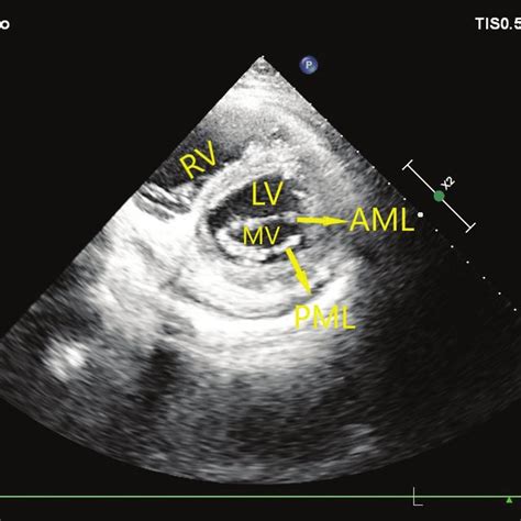 Preoperative Transthoracic Echocardiography Parasternal Long Axis