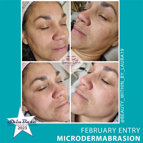 10 Microdermabrasion Benefits