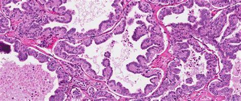 High Grade Prostatic Intraepithelial Neoplasia Ottawa Atlas Of Pathology