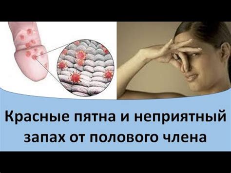 Красные пятна и неприятный запах от полового члена - YouTube