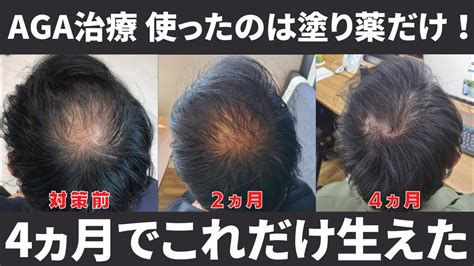 【薄毛で悩む人必見】25歳ハゲ Aga治療を始めて4ヵ月 想像以上に生えました！ Youtube