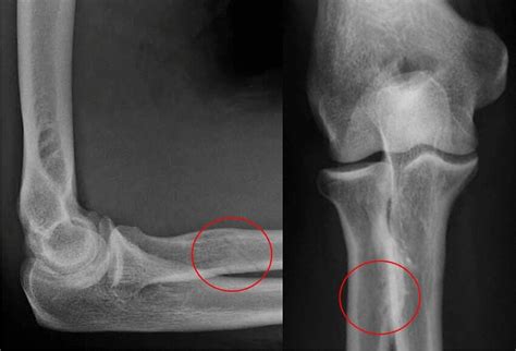 The Drill Holes In The Radial Tuberosity Can Be Seen On The