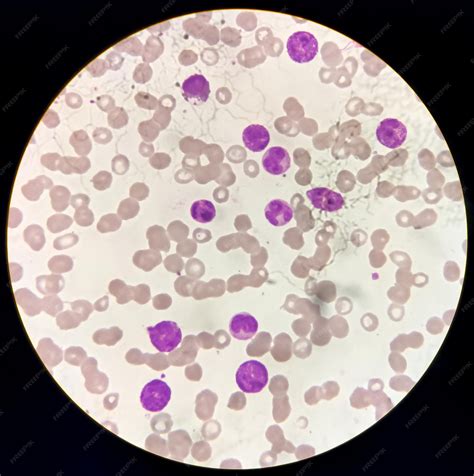 Premium Photo Chronic Myeloid Leukemia Cells Or Cml Analyze By Microscope Original