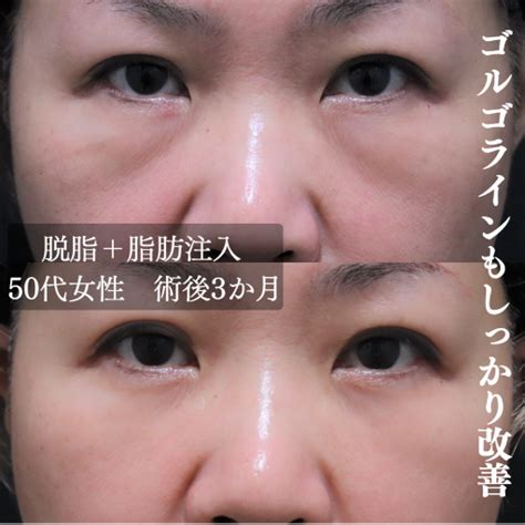50代女性 脱脂＋脂肪注入 3か月 目の下のクマ取りクリニック大阪梅田