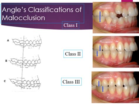 Canine Occlusion Classification Dog Malocclusion Treatment A