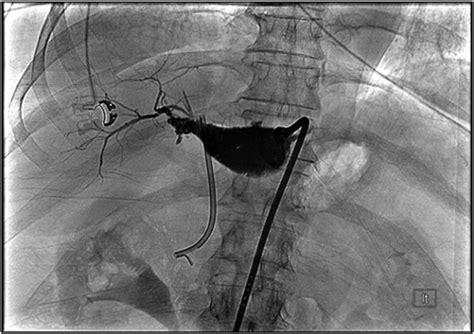 Tube Check Showing Disconnected Segments 5 And 6 Download Scientific