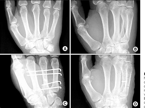 Figure 1 From Treatment Of Metacarpal Fractures Using Transverse Kirschner Wire Fixation