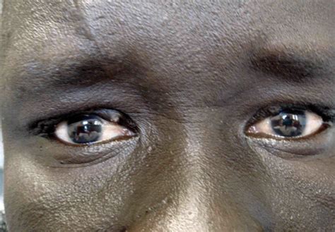 Normal Eyelashes Vs Distichiasis