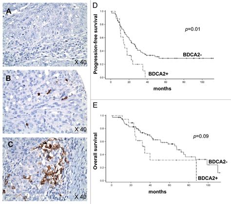 The Presence Of Plasmacytoid Dendritic Cells Pdc In Ovarian Cancer