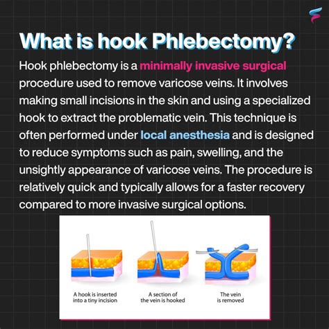 Dr Sumit Kapadia On Linkedin Hookphlebectomy Varicoseveins