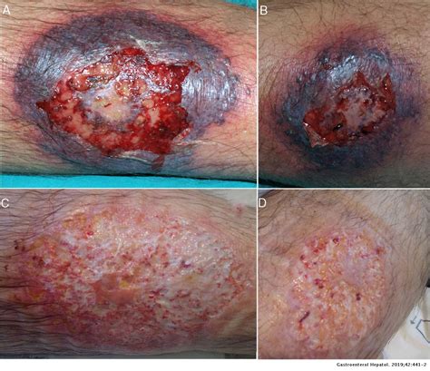 Pyoderma Gangrenosum Ibd