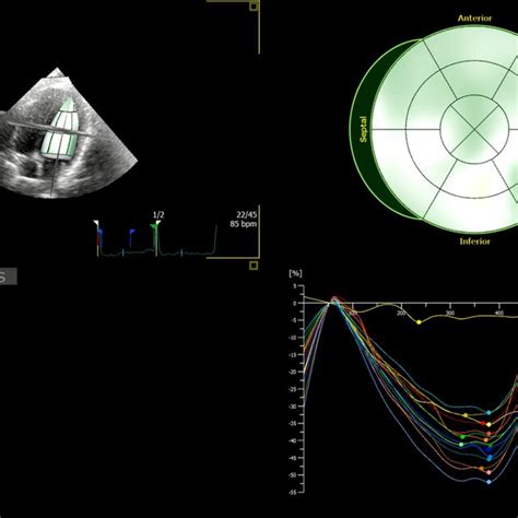 3d Lv Analysis Using Tomtech Dedicated Application For The Lv