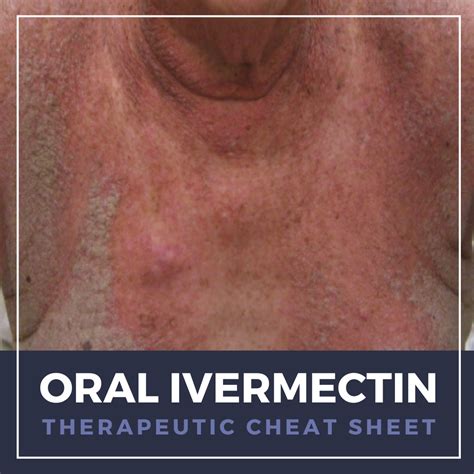 Ivermectin Safety Profile Archives Next Steps In Dermatology