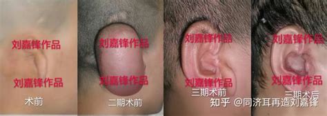 孩子耳朵像麻花妈妈说是爸爸遗传的奶奶却说是妈妈造成的 知乎