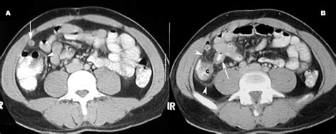 Appendicitis