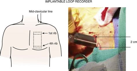 Diagnostic Aspects Of Implantable Devices Clinical Gate