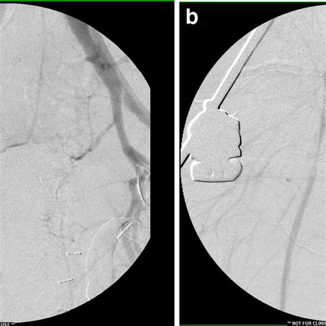 Pelvic Arteriogram Without Pelvic Arterial Contrast Extravasation A