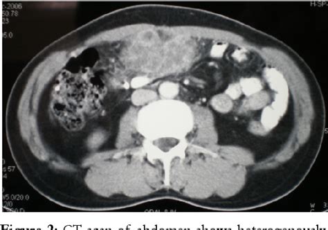 Figure 2 From Isolated Mesenteric Tuberculosis Presented As Abdominal