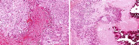 胎盘部位滋养细胞肿瘤（pstt）如何诊断？医学界 助力医生临床决策和职业成长
