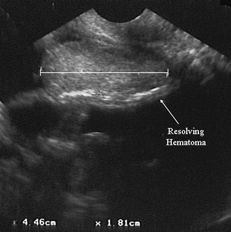 Bladder Hematoma After Vaginal Paracentesis Fertility And Sterility