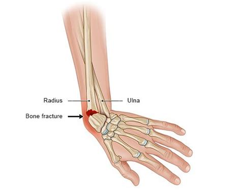 Wrist Injuries