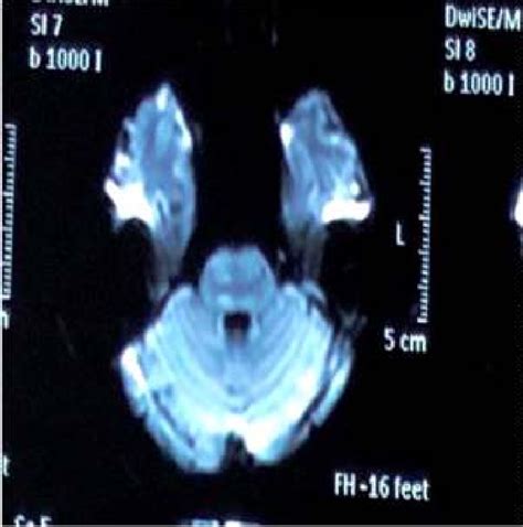 Mri Of The Brain Dwi Axial Section Showing Presence Of Reverse Hot