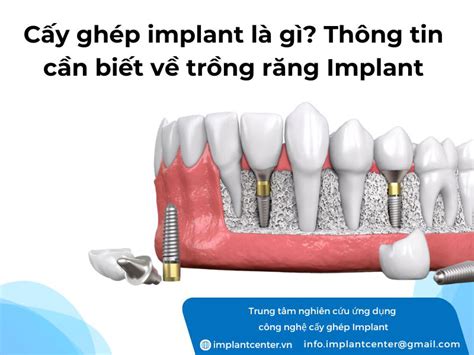 Trồng Răng Implant Khái Niệm Và Quy Trình Cấy Ghép Implant