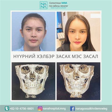 Nana Hospital Солонгосын Nana гоо сайхны эмнэлэг НАНА нүүрнийхэлбэрзасахмэсзасал Нүүрний