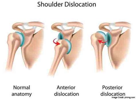 How To Treat And Heal A Joint Dislocation