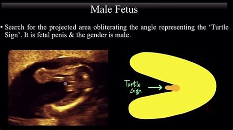 Aleena Qaiser On Linkedin Ultrasound Genderdetermination