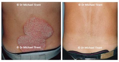 Những điều cần biết về corticoid điều trị bệnh vảy nến
