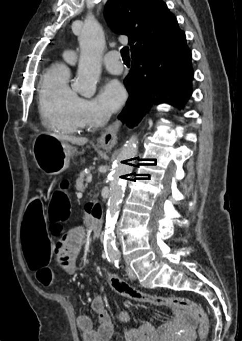 Chronic Mesenteric Ischaemia Presenting As Possible Large Bowl
