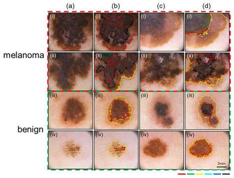 Benign Melanoma