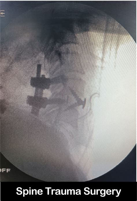Spinal Fracture Fixation For Improved Quality Of Life