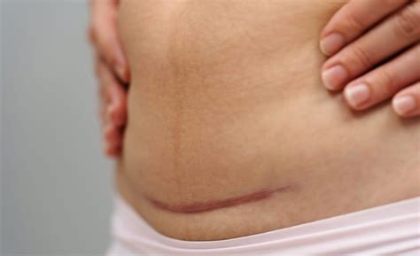 Ways To Keep The C Section Incision Dry When Overweight The Shoe Box Nyc