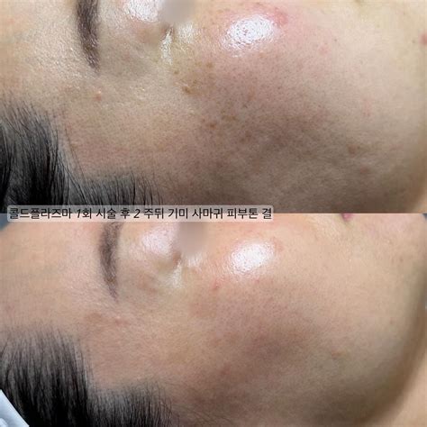 군산피부관리 군산여드름관리 군산콜드플라즈마 군산슈퍼젝션 군산웨딩관리 군산신부관리 군산피부창업반 콜드플라즈마 임상 너무 많은데 여름 성수기 때문에 오랜만에 인스타 업로드