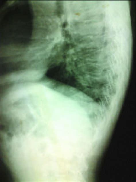 X Ray Dorsolumber Spine Showing Anterior Vertebral Beaking And
