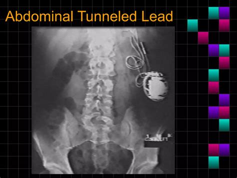 Pacemaker Radiologyanintroduction Ppt