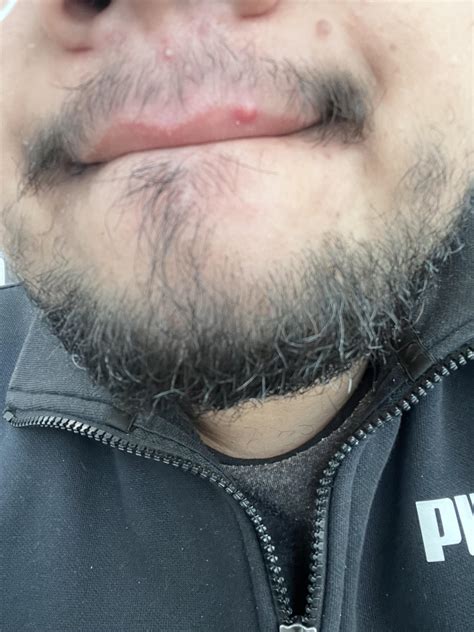 Bump On Upper Lip R Skin