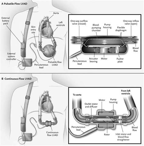 Panel A Shows A First Generation Pulsatile Flow Left Ventricular Assist